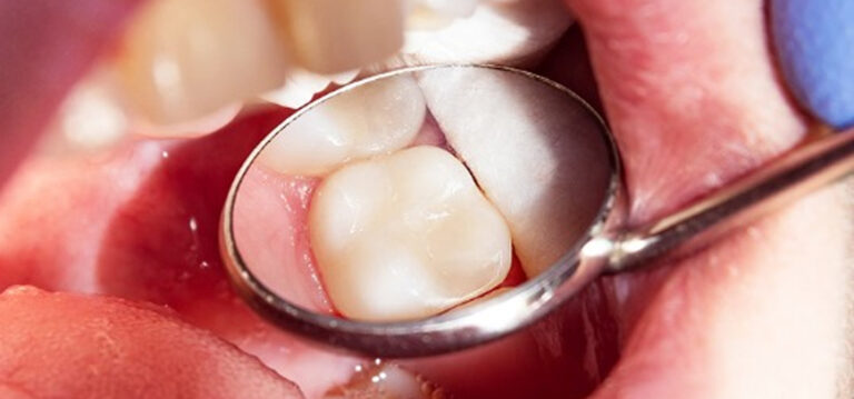 Embedded Teeth